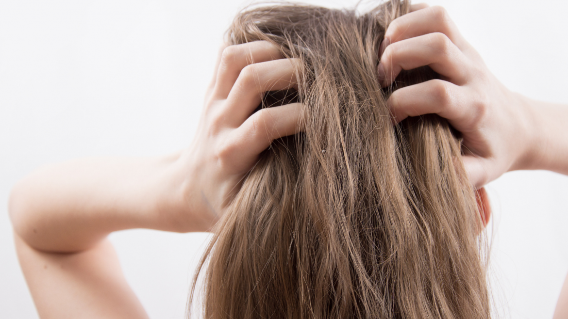 Psoriasis cuir chevelu : Symptômes, causes, solutions